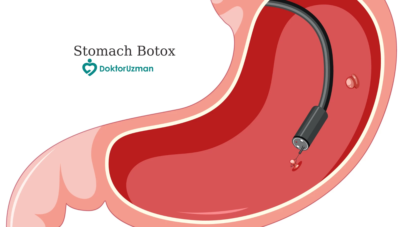 Stomach Botox - General Surgery - Opr. Dr. General Surgery